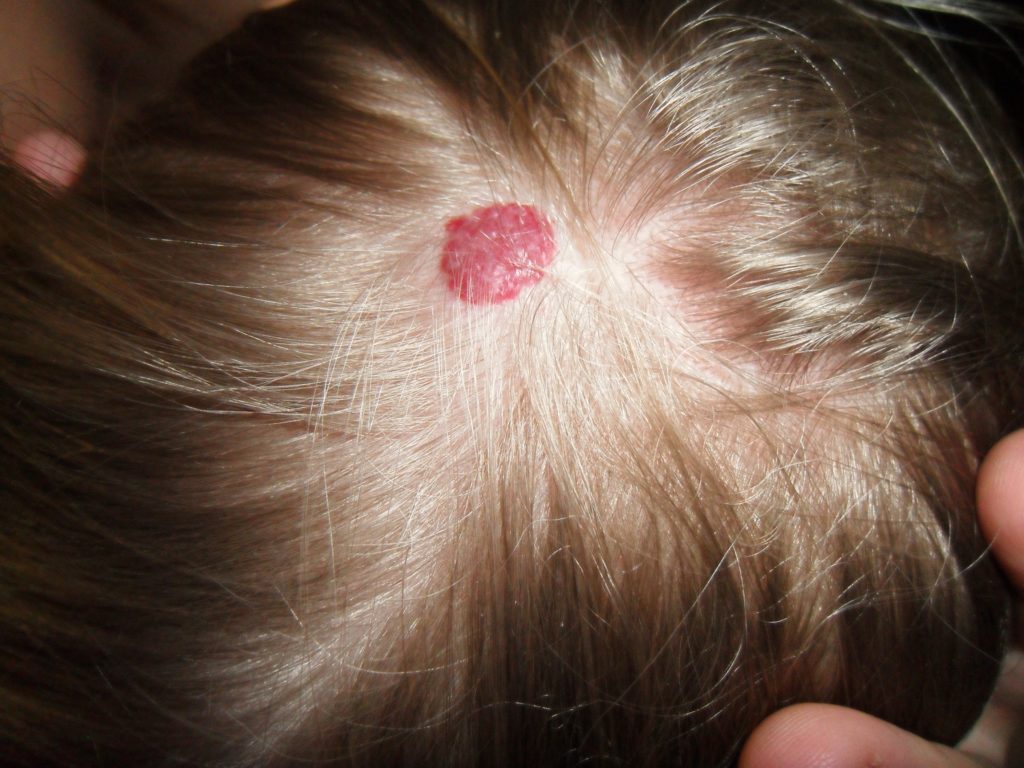 All About Strawberry Hemangioma - Appearance, Causes and Treatment