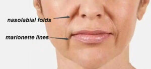 Best Treatments for Marionette Lines - FixTheLife